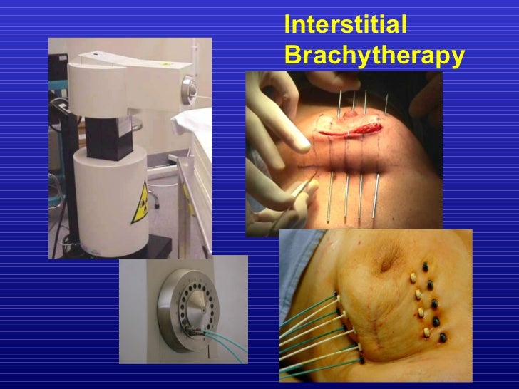BALKAN MCO 2011 - E. Vrdoljak - Radiotherapy