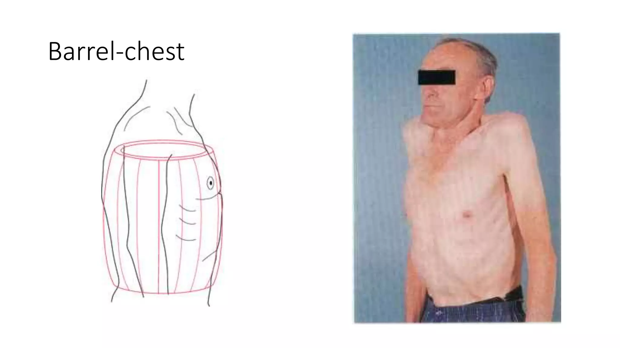 1-4syndromes in Disorders of the Respiratory .pptx