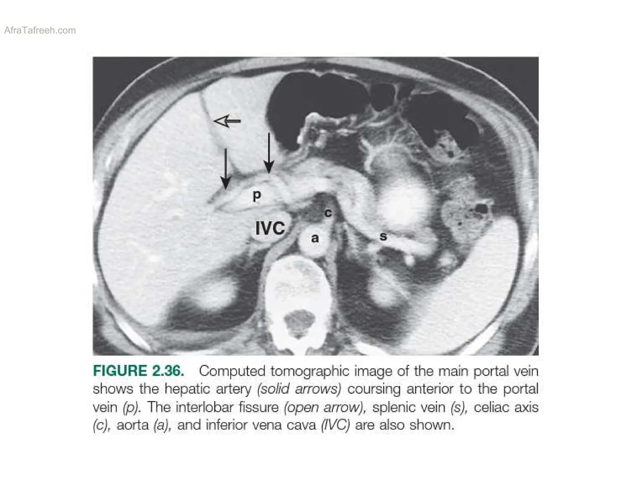 1-Anatomy and Embryology of Pancreas pdfpdf | PDF | Endocrine and ...