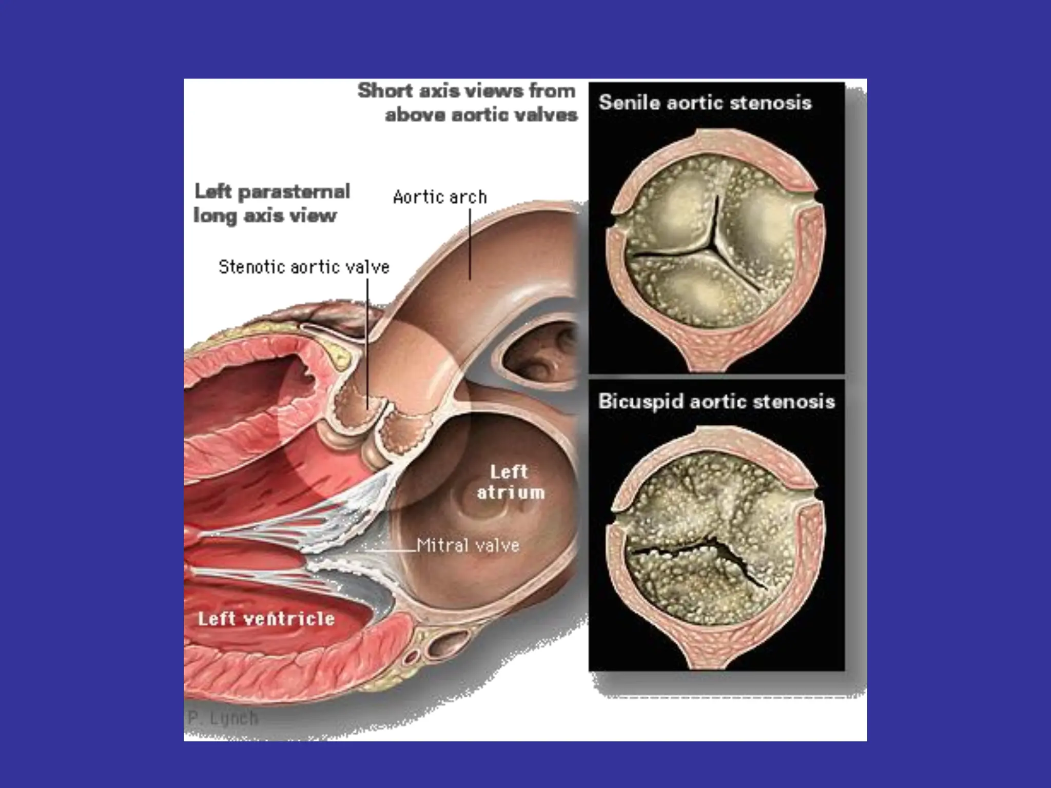 1- Aortic Valve Diseases Cardiovascular Module | PDF