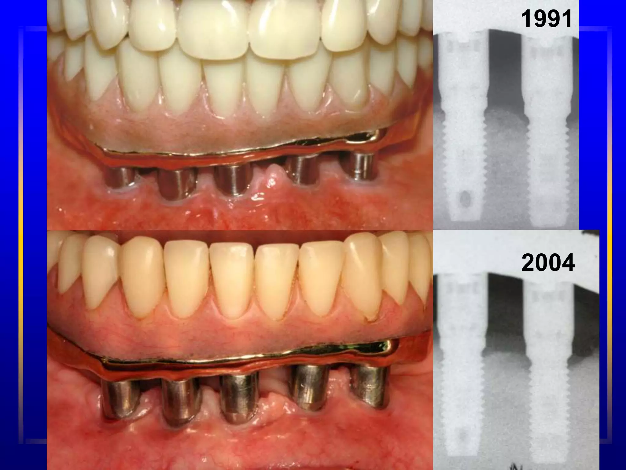 Benefits of Implant Dentistry.ppt
