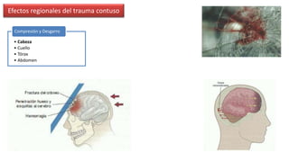 Biomecánica del trauma | PPTX