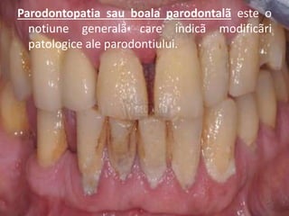 1-Boala-Parodontala.................pptx