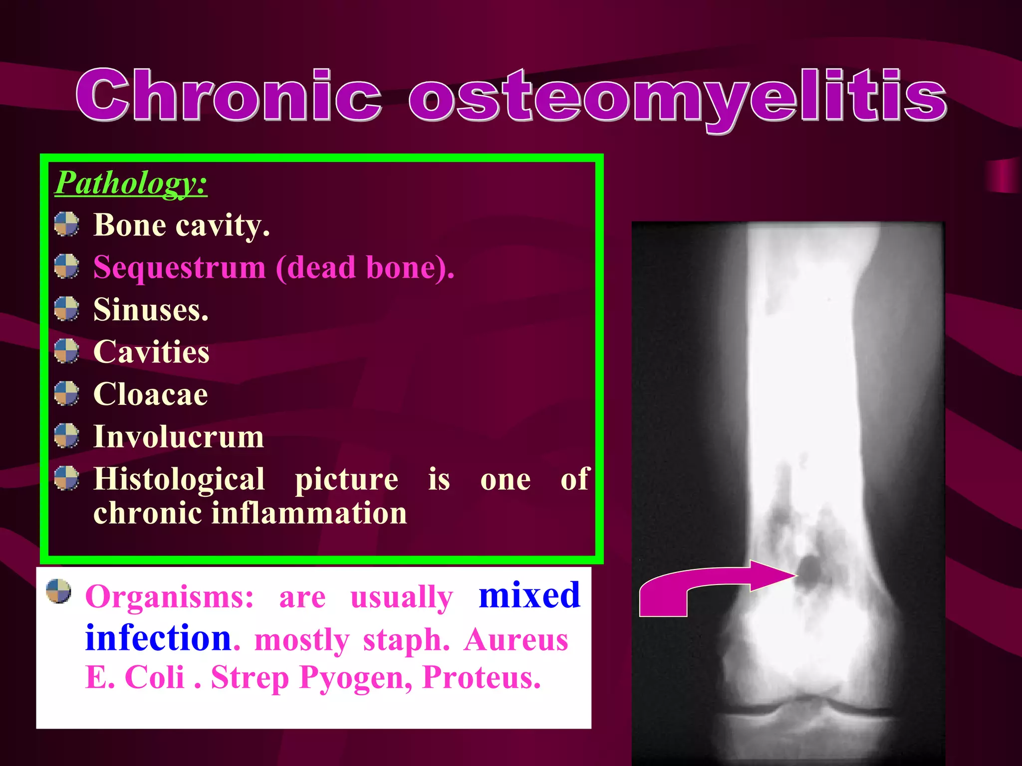 Bone and Joint Infection | PPT