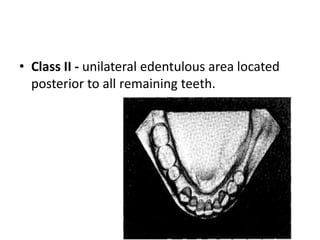 1-CLASSIFICATION OF RPD 1 copy.pptx