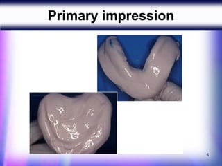 1.complete denture (power point) | PPT