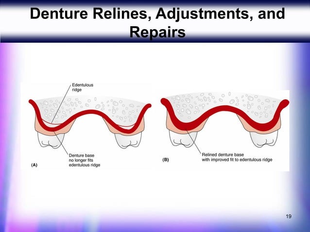 1.complete denture (power point)