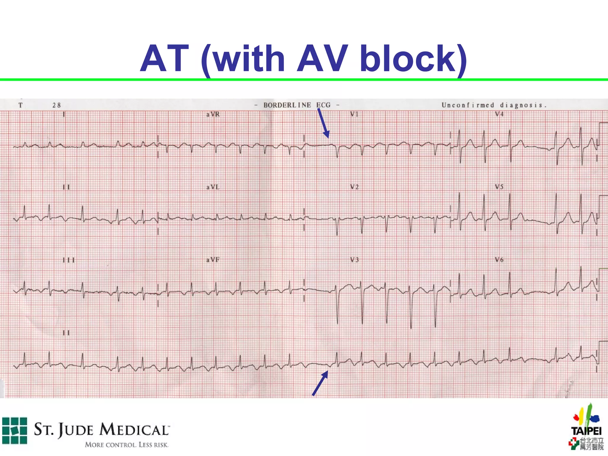 Complex svt with differentiation | PPT