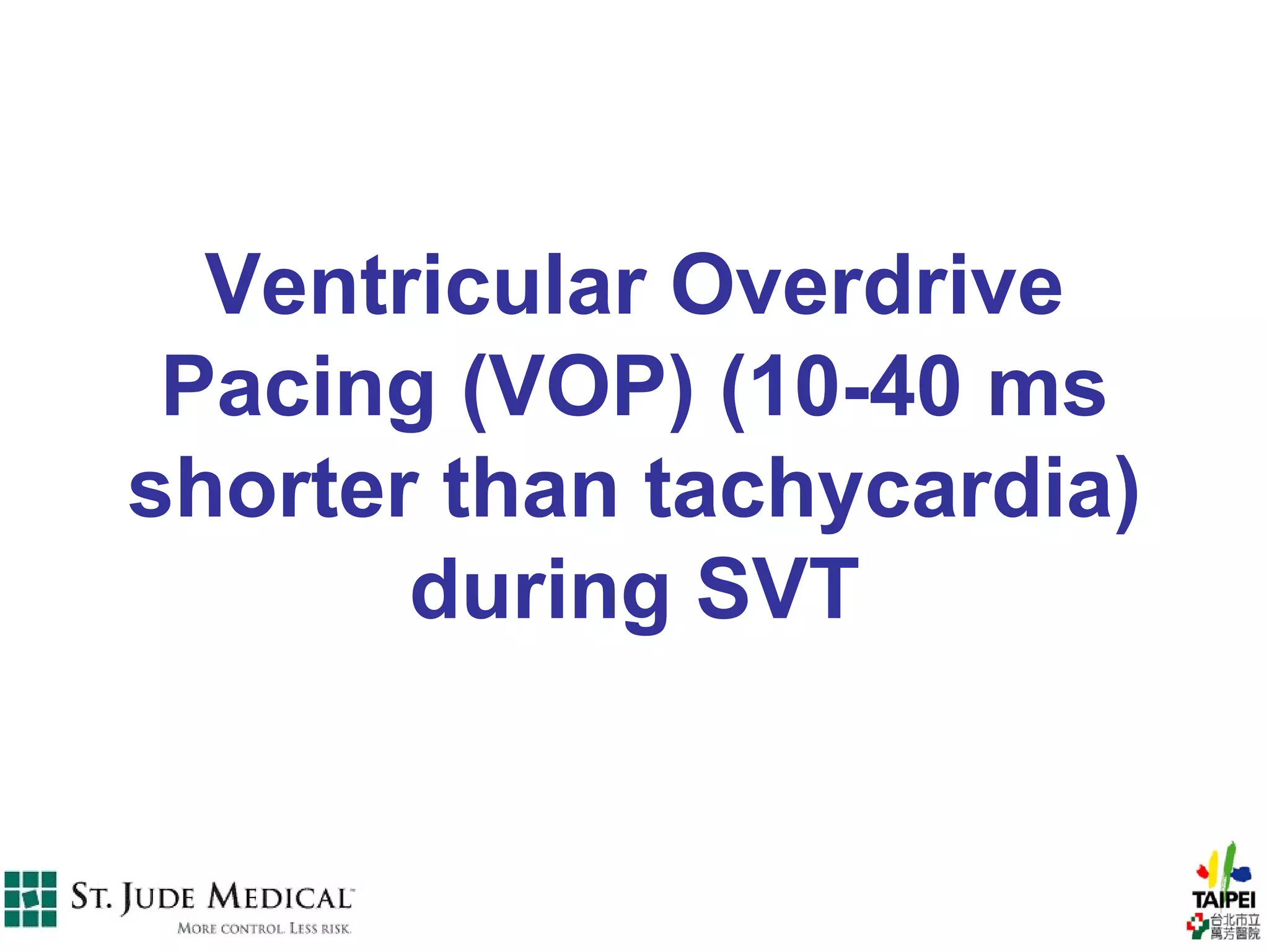 Complex svt with differentiation | PPT