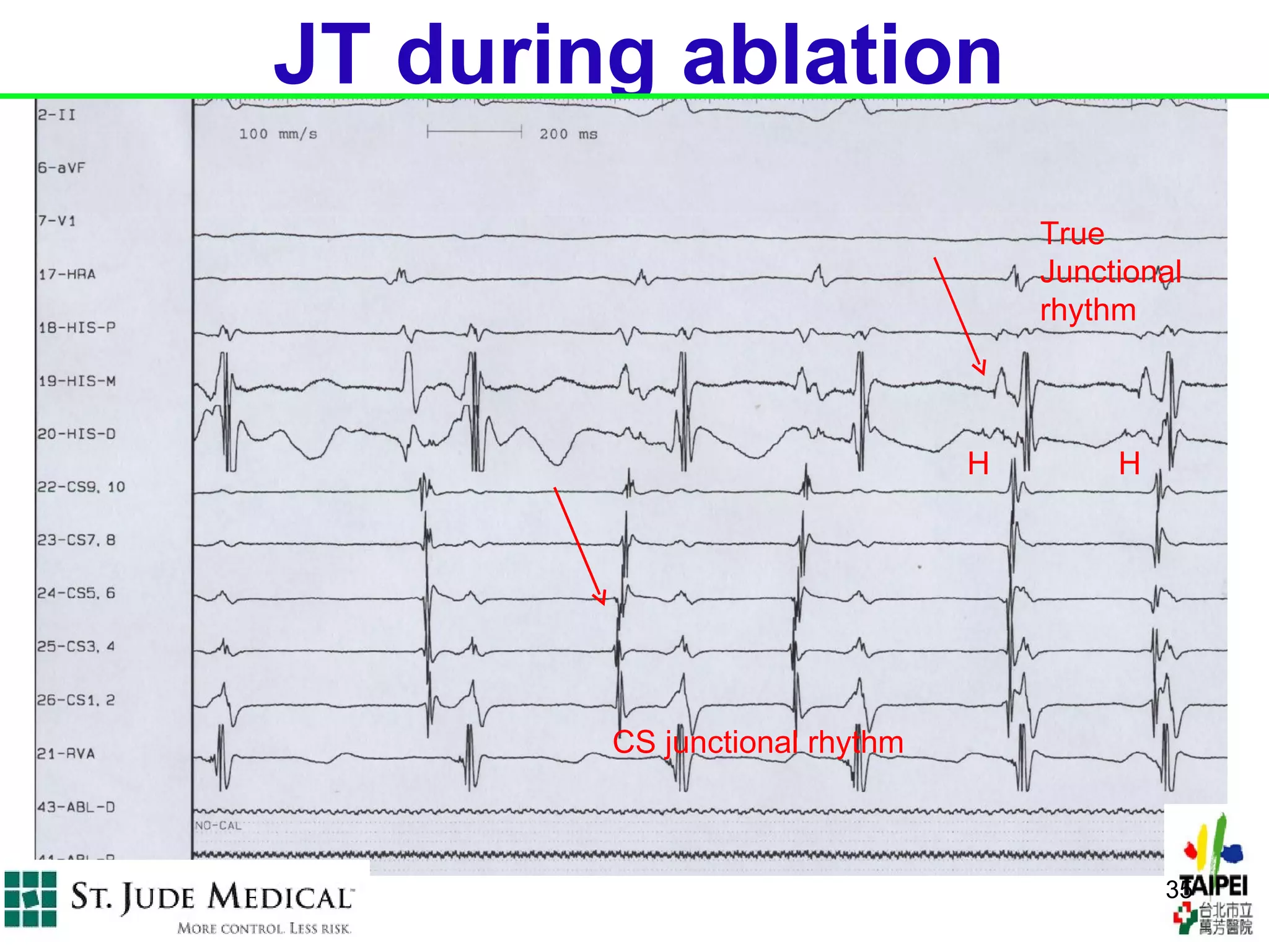Complex svt with differentiation | PPT