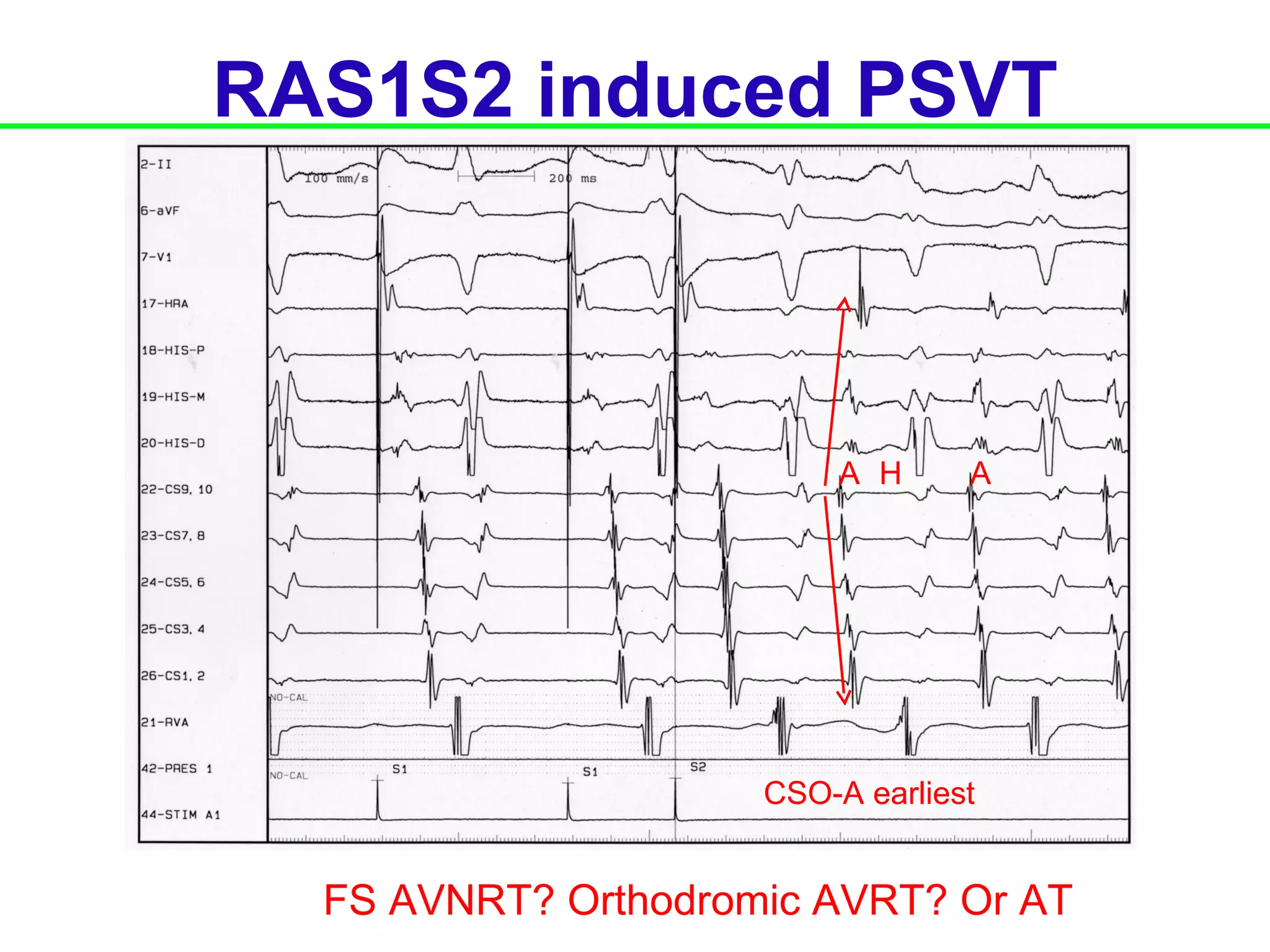 Complex svt with differentiation | PPT