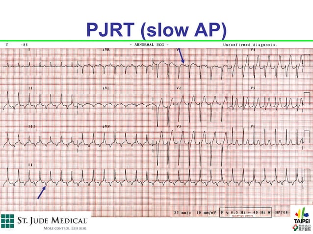 Complex svt with differentiation | PPT | Heart and Cardiovascular ...