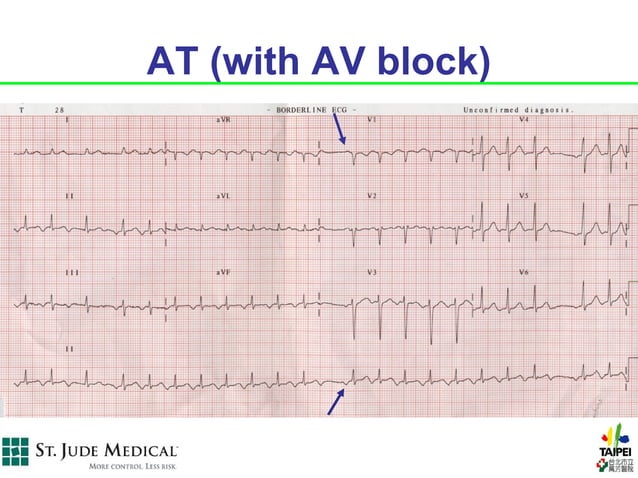 Complex svt with differentiation | PPT | Heart and Cardiovascular ...
