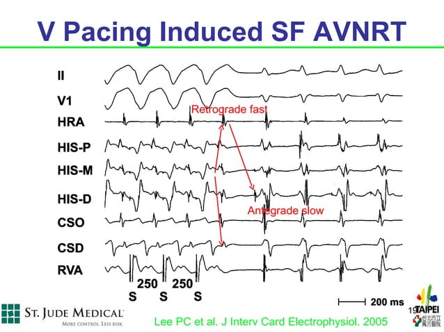 Complex svt with differentiation | PPT | Heart and Cardiovascular ...