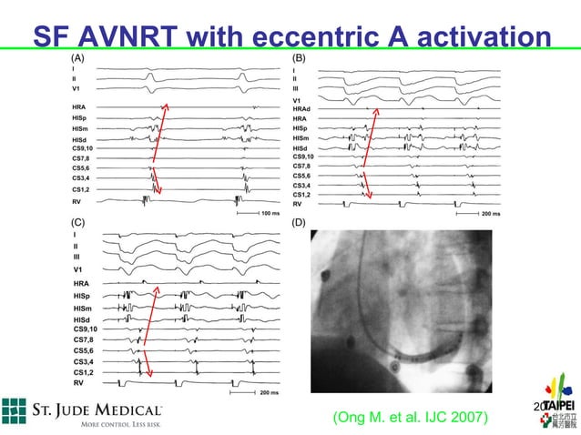Complex svt with differentiation | PPT | Heart and Cardiovascular ...