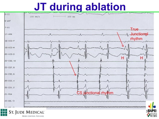 Complex svt with differentiation | PPT | Heart and Cardiovascular ...