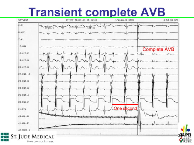 Complex svt with differentiation | PPT | Heart and Cardiovascular ...