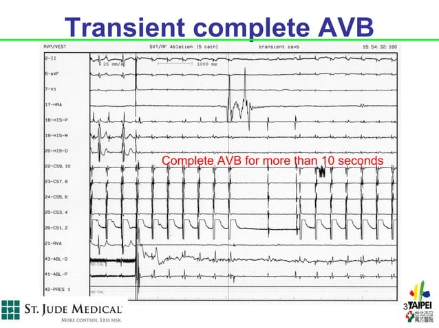 Complex svt with differentiation | PPT | Heart and Cardiovascular ...