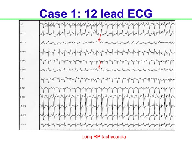 Complex svt with differentiation | PPT | Heart and Cardiovascular ...