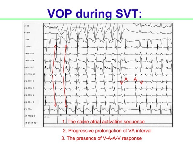 Complex svt with differentiation | PPT | Heart and Cardiovascular ...