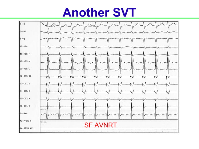 Complex svt with differentiation | PPT | Heart and Cardiovascular ...