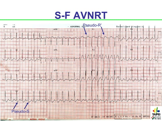 Complex svt with differentiation | PPT | Heart and Cardiovascular ...