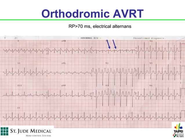 Complex svt with differentiation | PPT