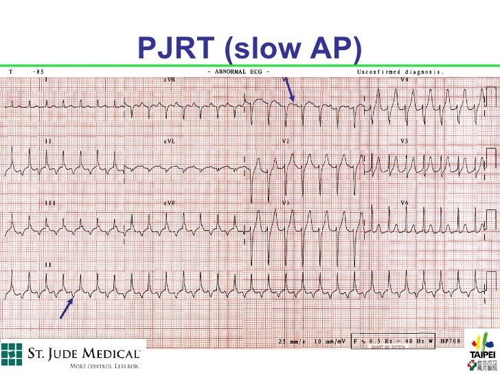 Complex svt with differentiation