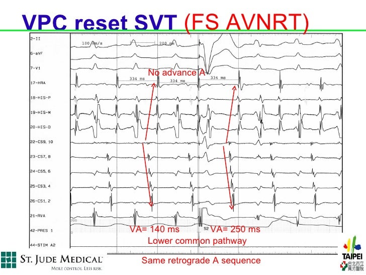 Complex svt with differentiation