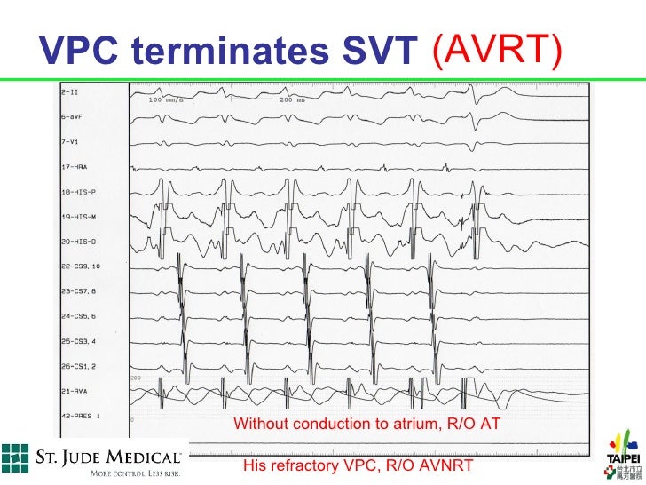 Complex svt with differentiation