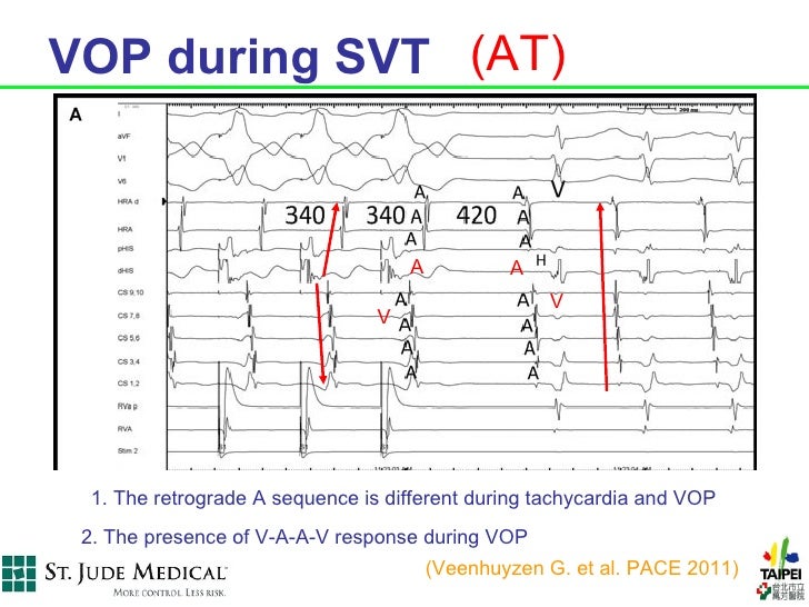 Complex svt with differentiation