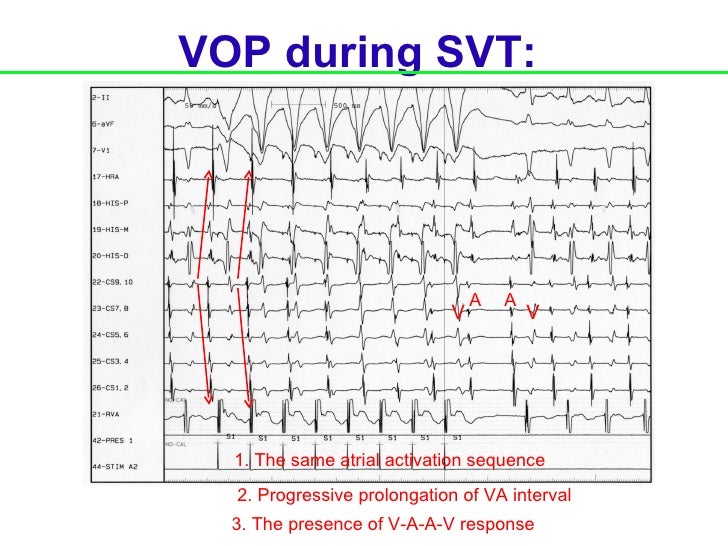 Complex svt with differentiation