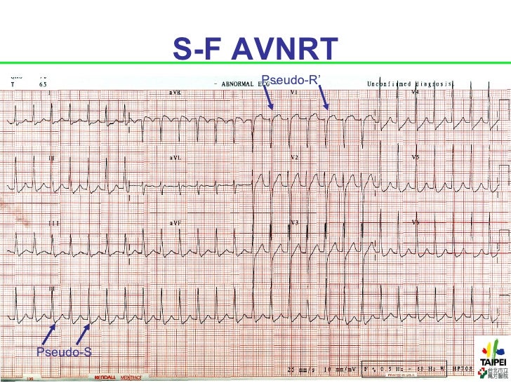 Complex svt with differentiation