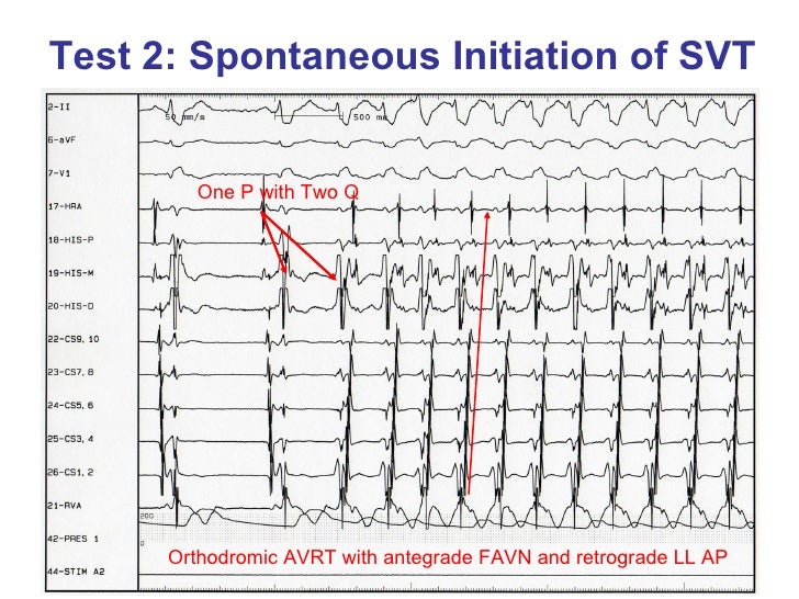 Complex svt with differentiation