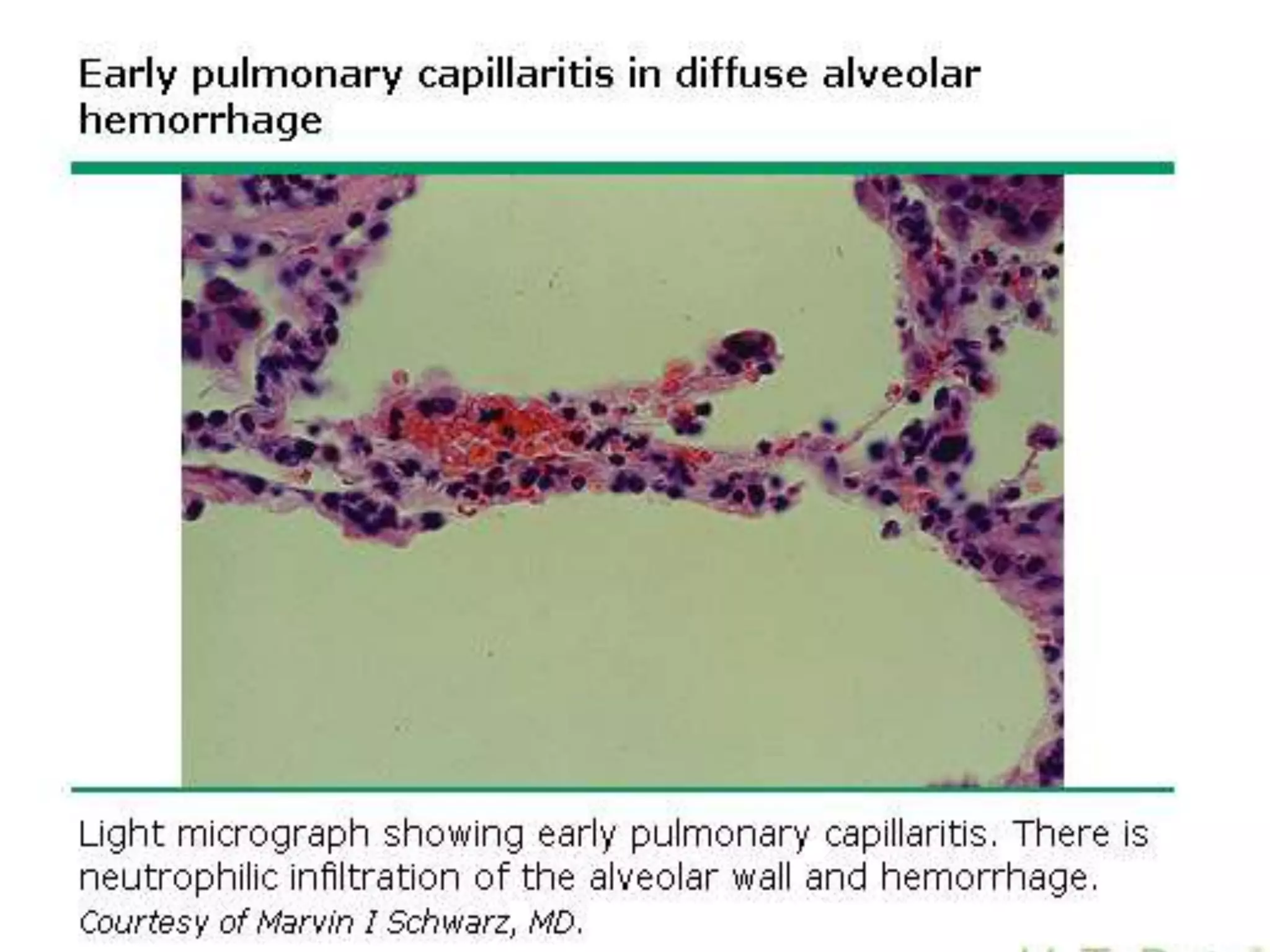 DIFFUSE ALVEOLAR HAEMORRHAGE | PPTX
