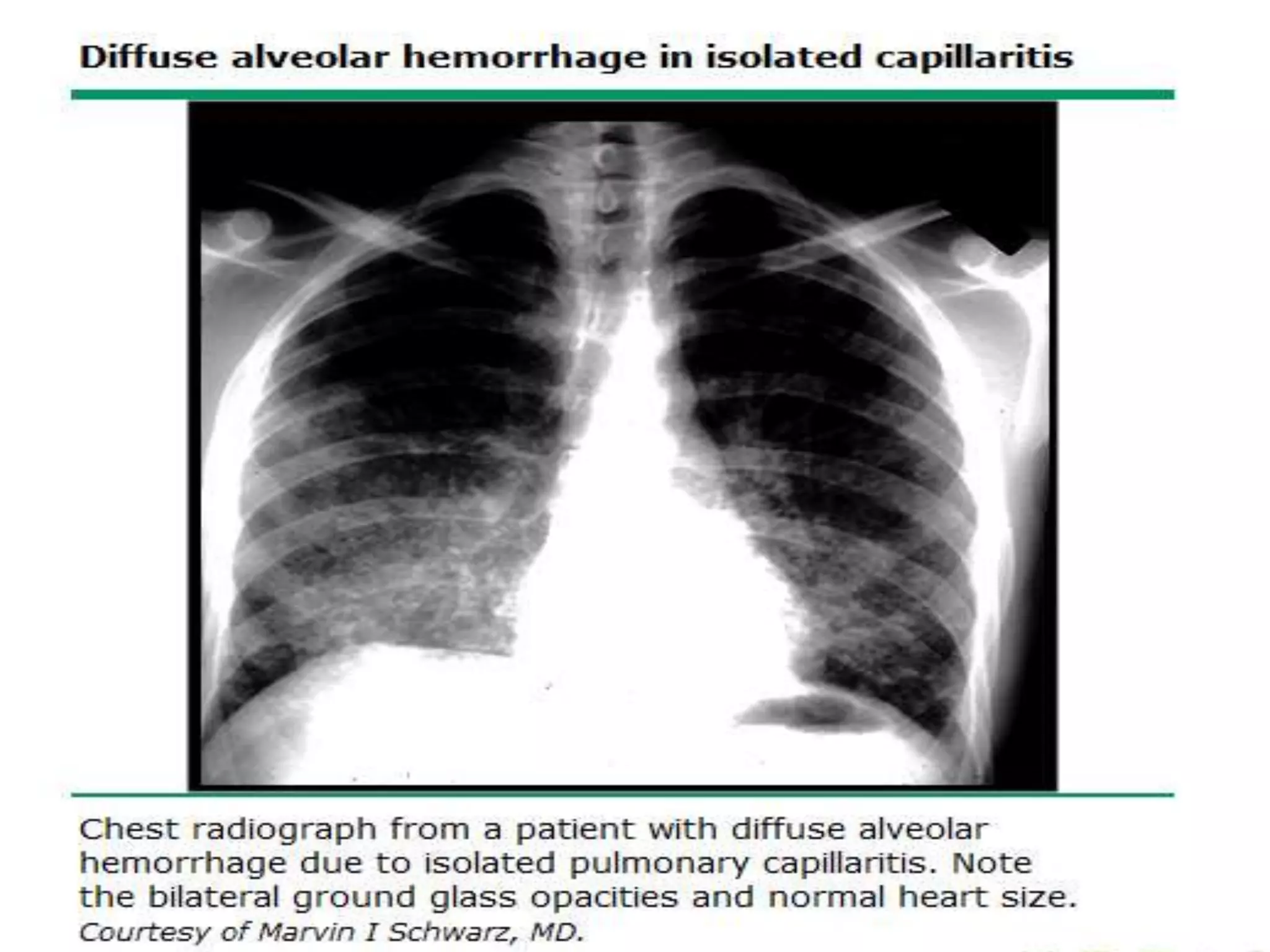 DIFFUSE ALVEOLAR HAEMORRHAGE | PPTX