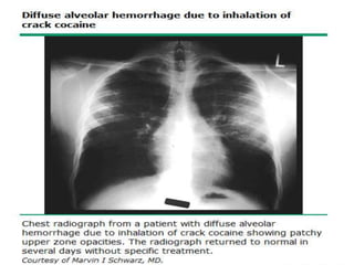 DIFFUSE ALVEOLAR HAEMORRHAGE | PPTX