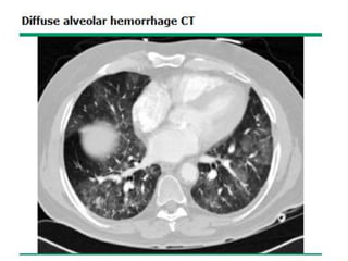 DIFFUSE ALVEOLAR HAEMORRHAGE | PPTX