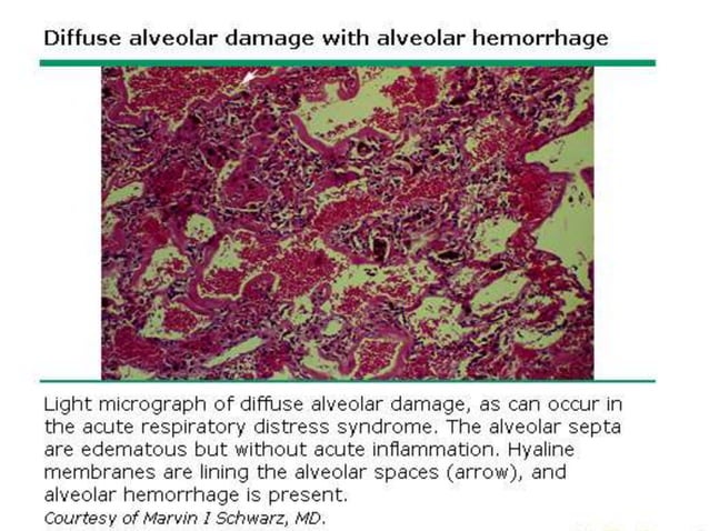 DIFFUSE ALVEOLAR HAEMORRHAGE | PPTX | Lung and Respiratory Health ...