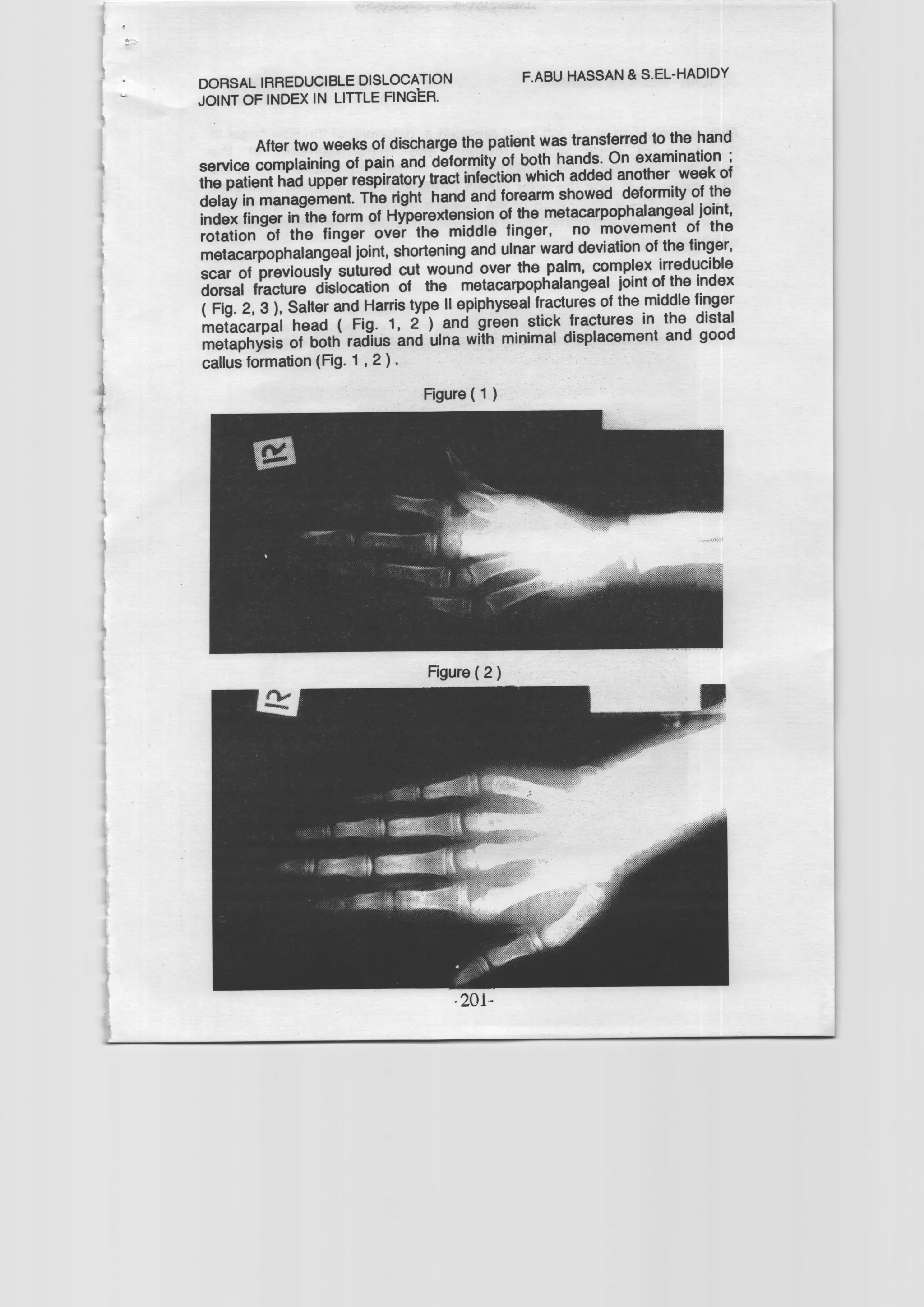 complex fracture dislocation of the index finger -البروفيسور فريح ...