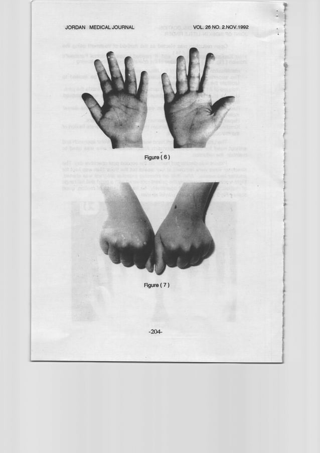 complex fracture dislocation of the index finger -البروفيسور فريح ...