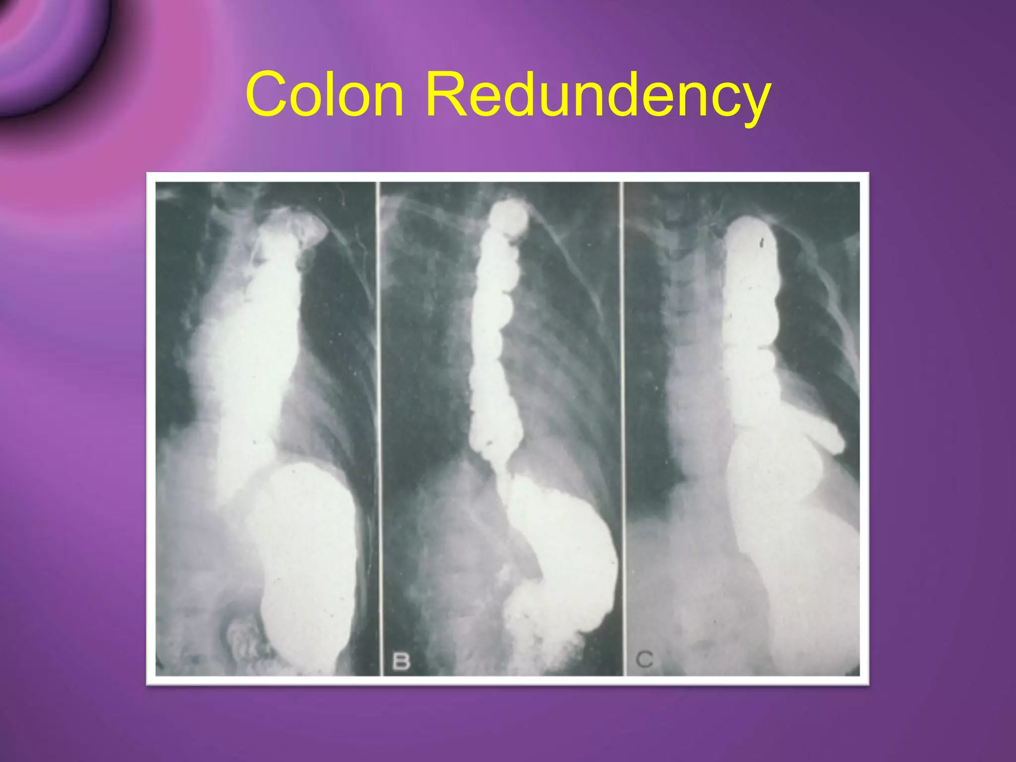 Esophaegeal resection & reconstruction | PPT