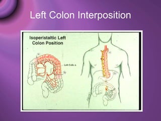 Esophaegeal resection & reconstruction | PPT