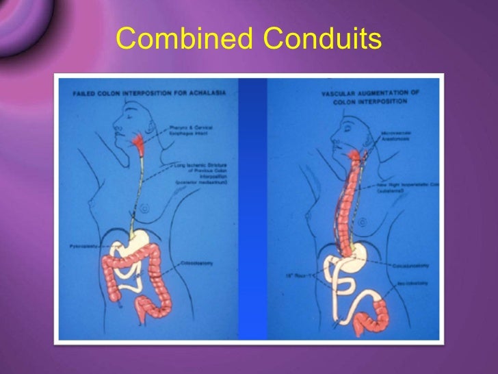 Esophaegeal resection & reconstruction