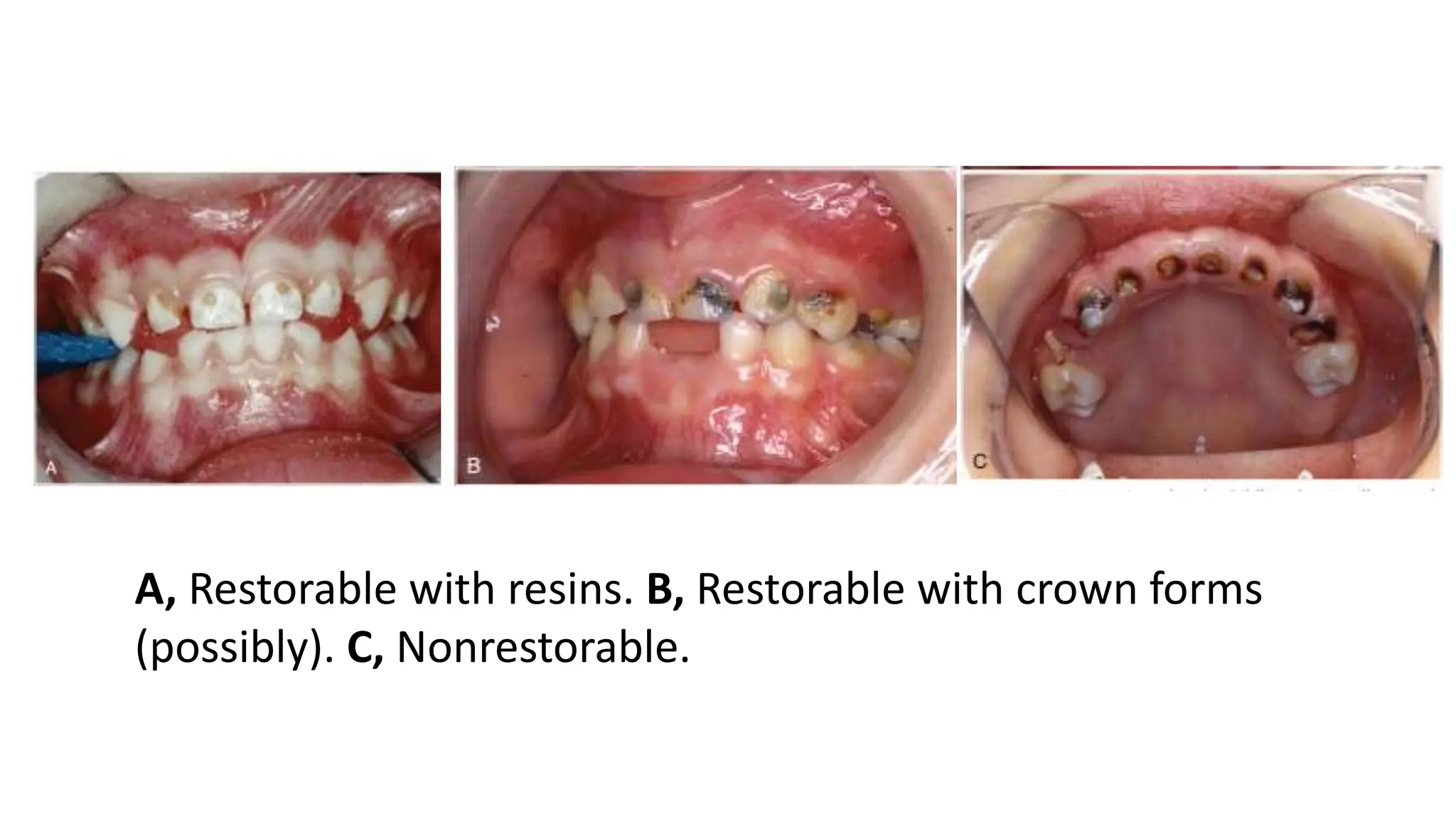 1 - ECC, Nursing Caries and Rampant Caries.pptx