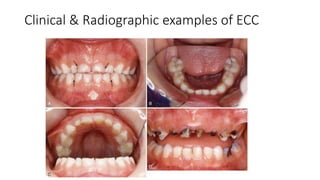 1 - ECC, Nursing Caries and Rampant Caries.pptx