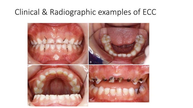 1 - ECC, Nursing Caries and Rampant Caries.pptx | Dental Health ...