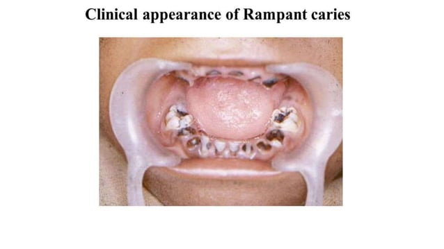 1 - ECC, Nursing Caries and Rampant Caries.pptx | Dental Health ...