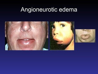 1 edema | PPT