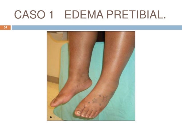 1 Fisiopatología del EDEMA (2012)